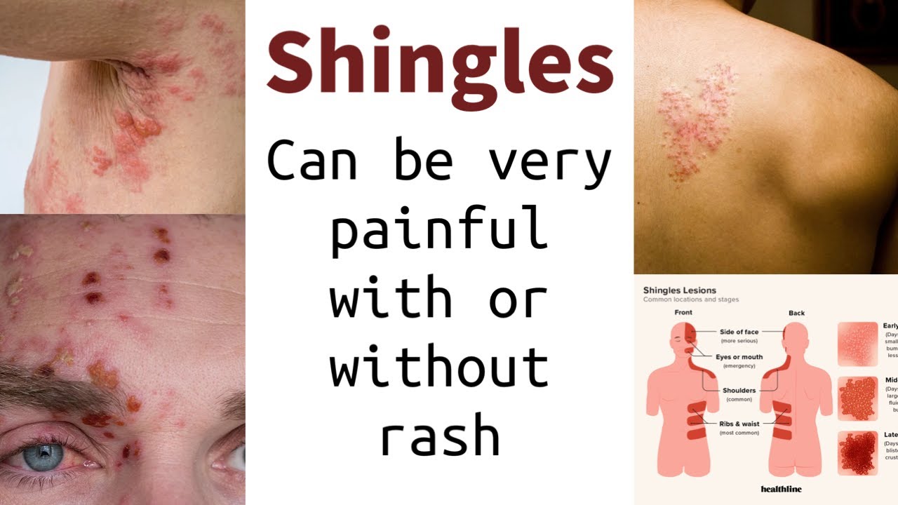 Shingles symptoms, causes, diagnosis & treatment - YouTube
