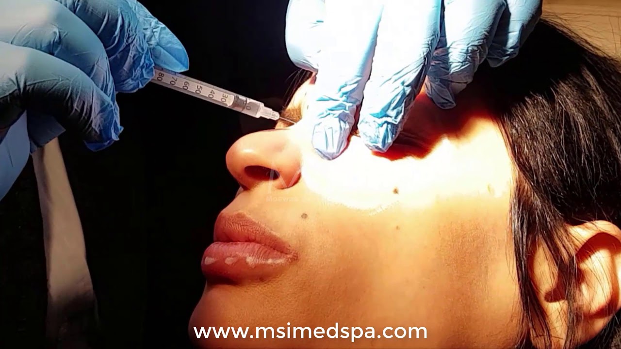 BOTOX INJECTIONS. UPPER FACE - YouTube