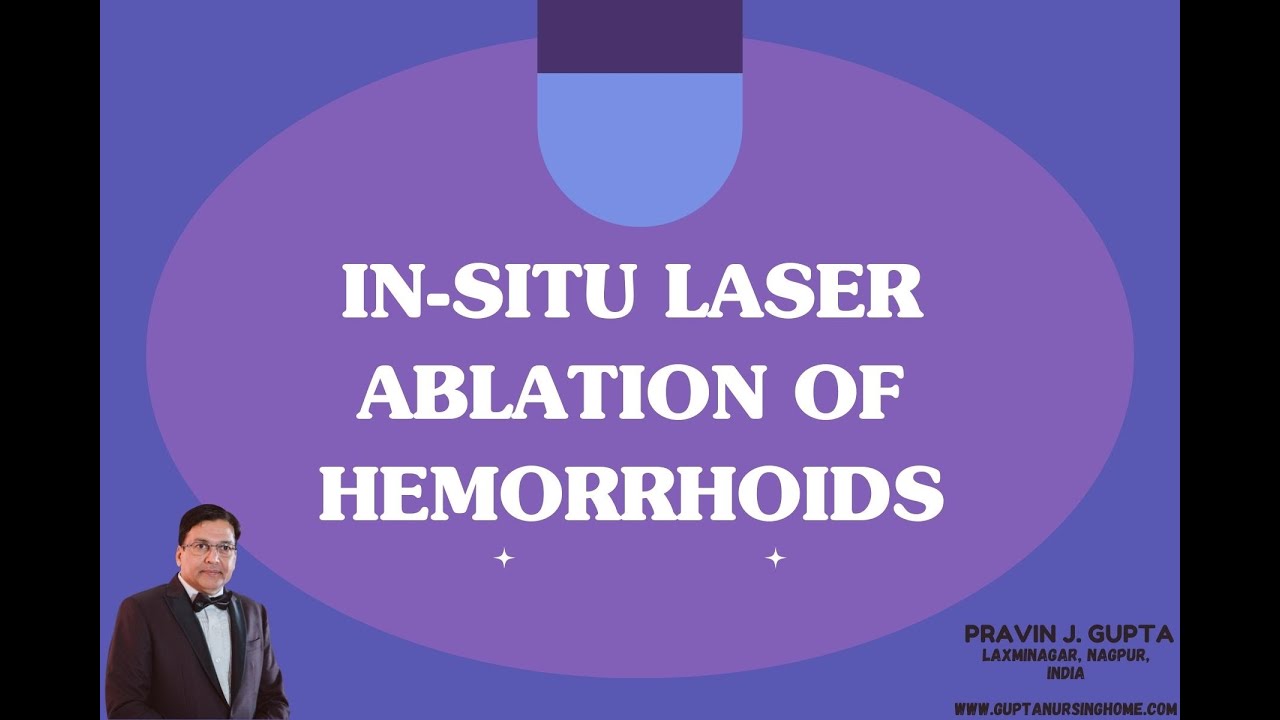 A TAILORED LASER PROCEDURE FOR MIXED HEMORRHOIDS - YouTube