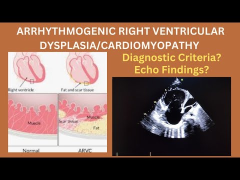 Arrhythmogenic Right Ventricular Dysplasia/Cardiomyopathy(ARVD/ARVC ...