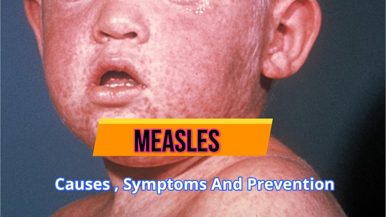 What Is Measles - Its Causes, Symptoms, diagnosis, & Prevention ...
