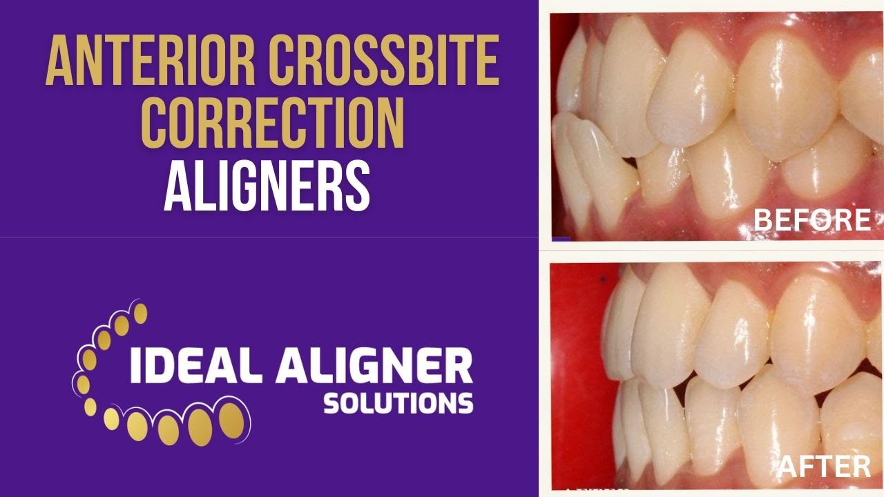 dental crossbite correction - aligners/ ideal aligner solution/custom ...