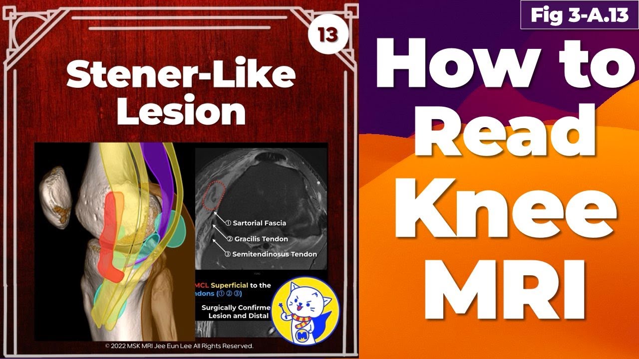 (Fig 3-A.13) Stener-like lesion of MCL, avulsed distal MCL retracted ...