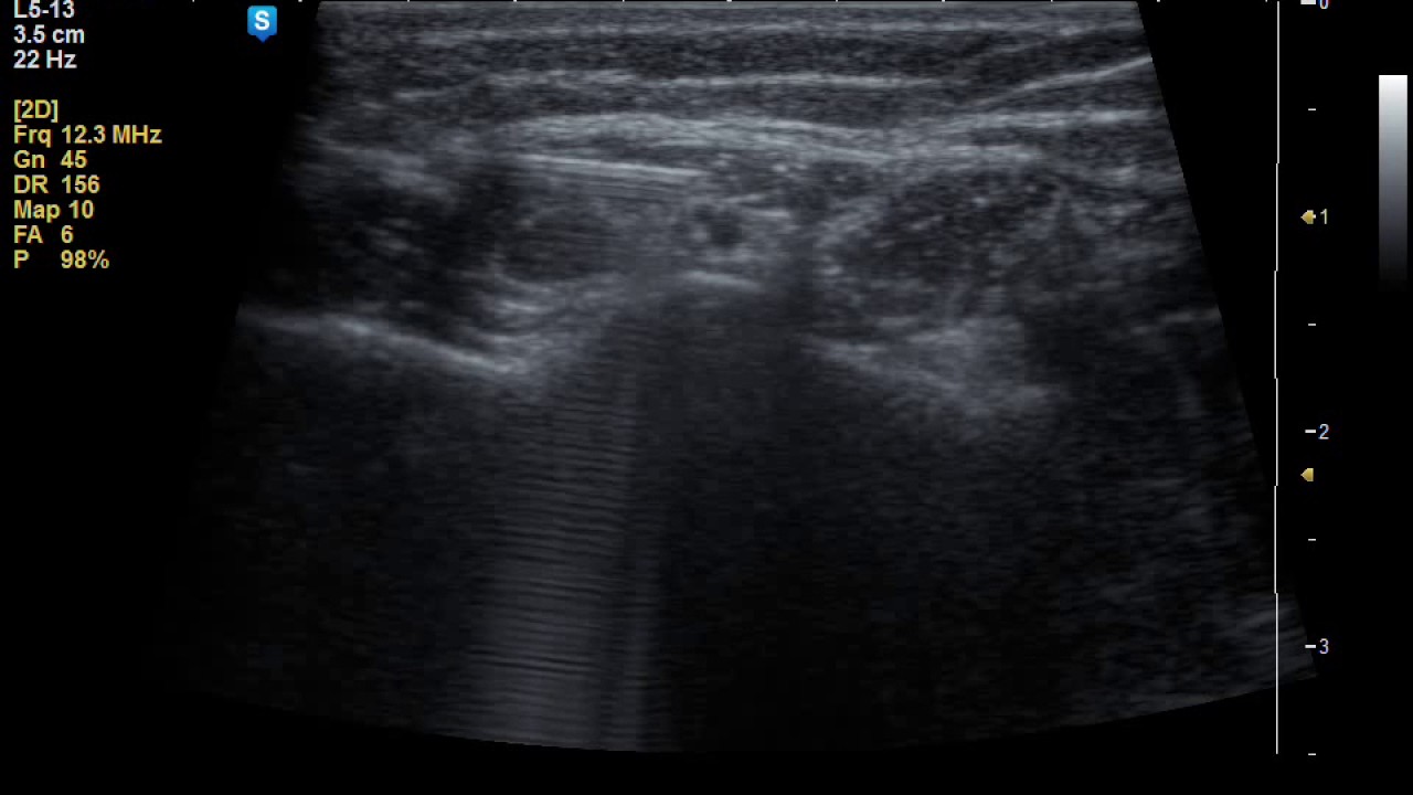 Ultrasound guided hydro-dissection of the ulnar nerve between 2 heads ...