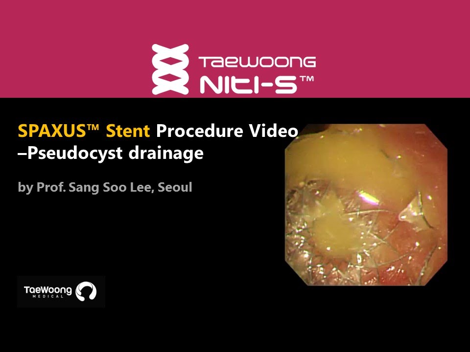 Niti S™ Gastrointestinal Metal Stent:: SPAXUS™ Stent Procedure video ...
