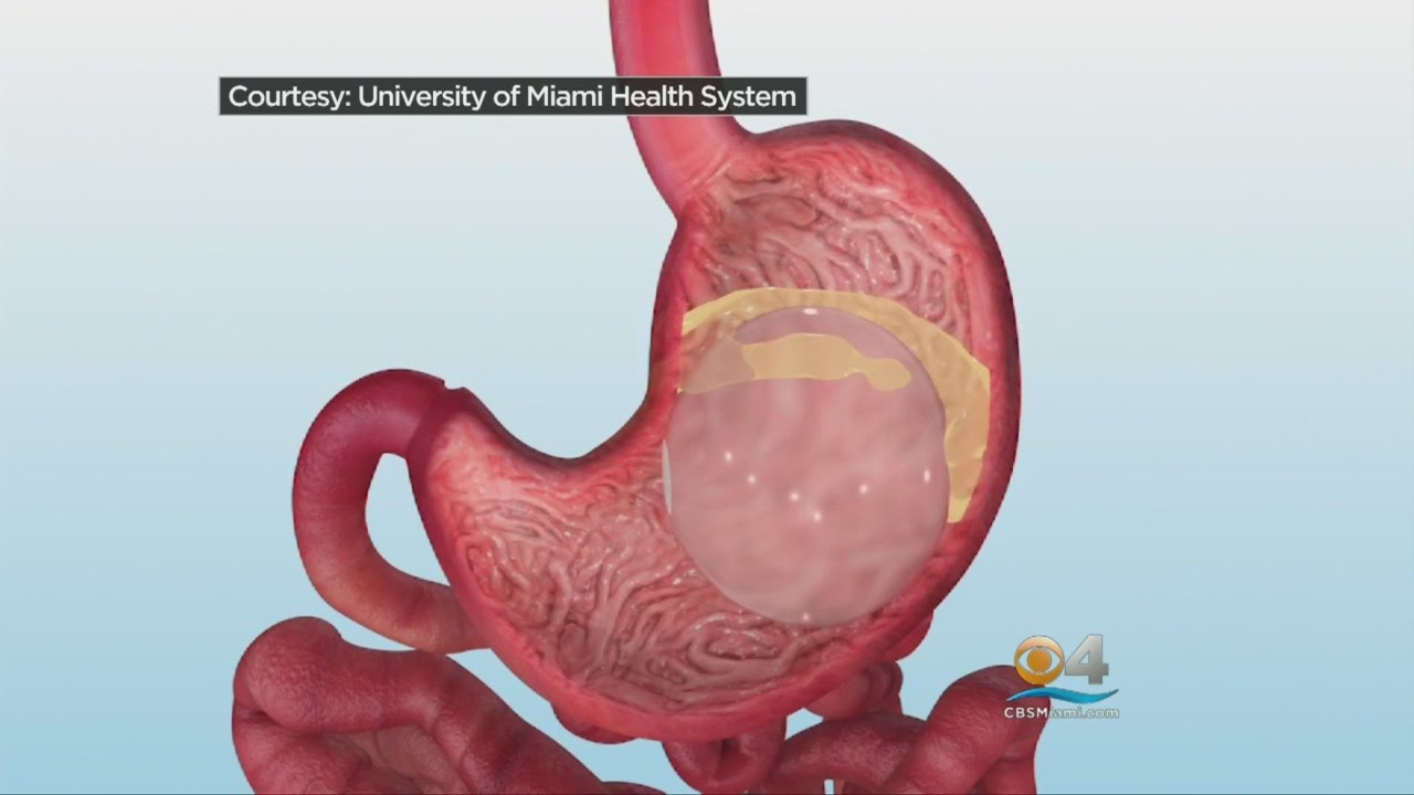 Gastric Balloon Could Inflate Your Weight-Loss Success - YouTube