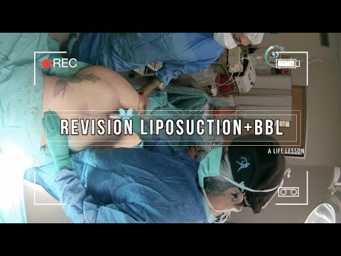 Transform Your Silhouette with BBL Revision Surgery - YouTube
