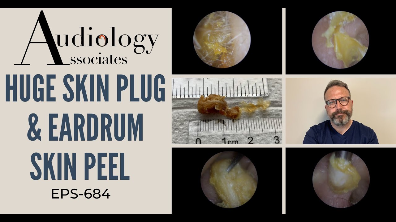 HUGE SKIN PLUG & EARDRUM SKIN PEEL - EP684 - YouTube