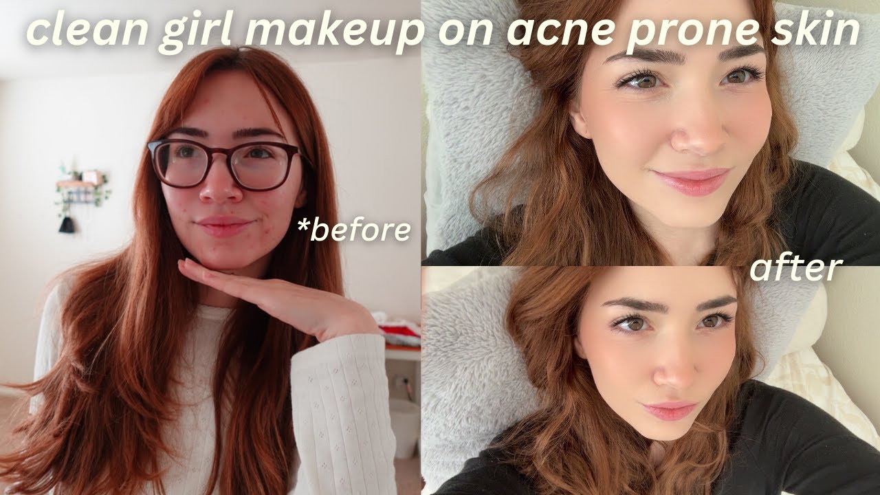 glowy clean girl makeup on acne prone skin | tips & tricks from my ...