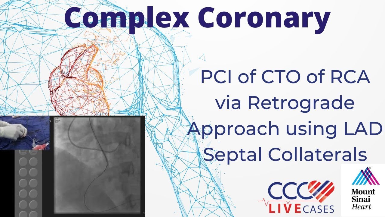 PCI of CTO of RCA via Retrograde Approach using LAD Septal Collaterals ...