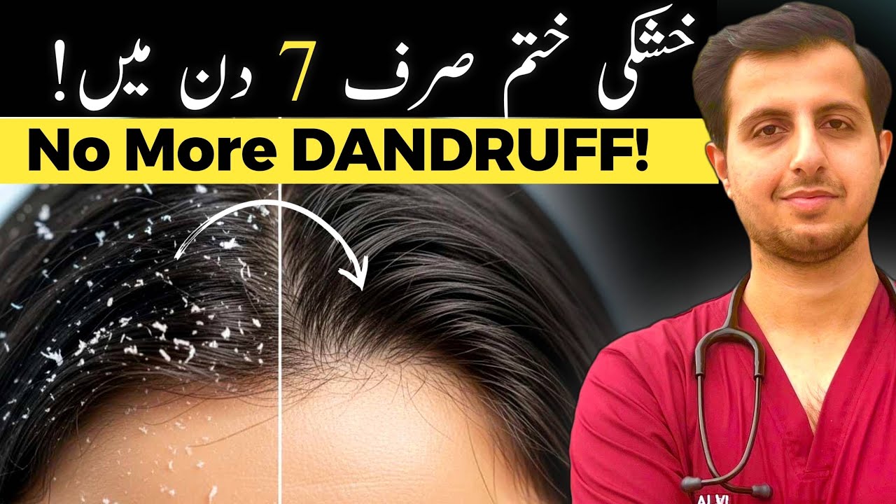 The Real Cause And Cure For Dandruff | بالوں کی خشکی ختم - YouTube