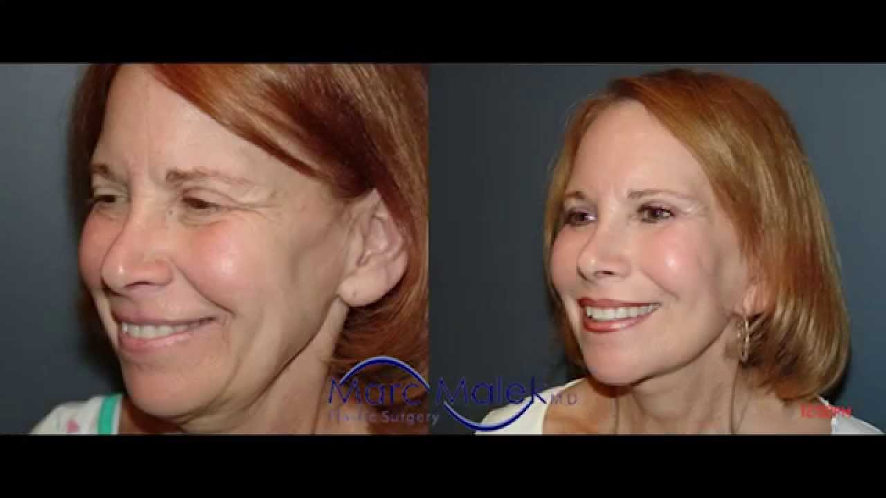 Dr. Marc Malek MD - Facial Rejuvenation - YouTube