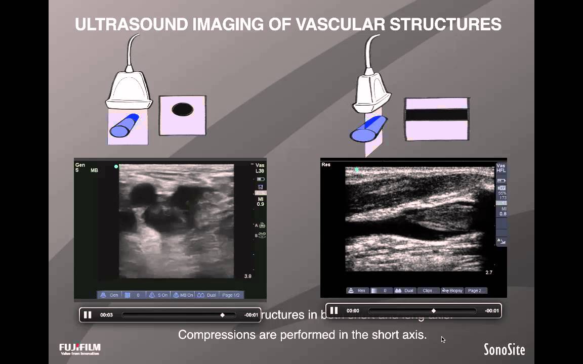Webinar: Point-of-Care Ultrasound for the Detection of Lower Extremity ...