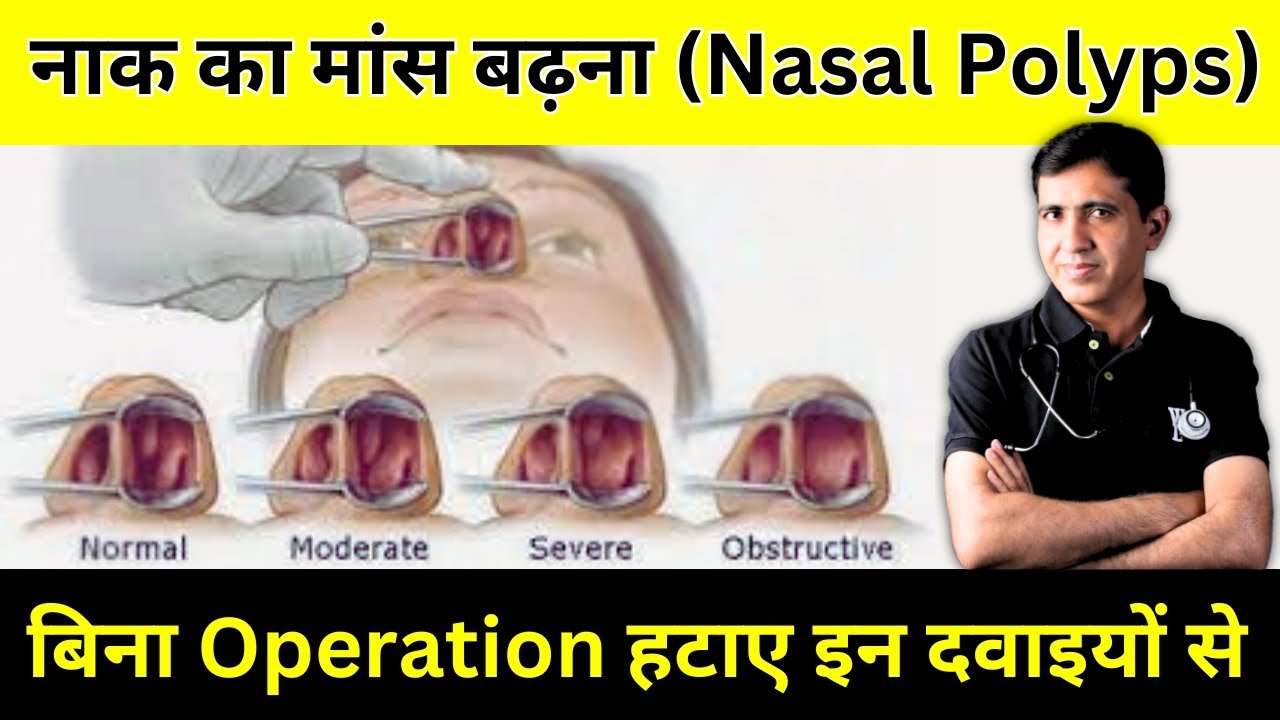 Nasal Polyps | नाक का मांस बढ़ने के लक्षण, कारण व इलाज - YouTube