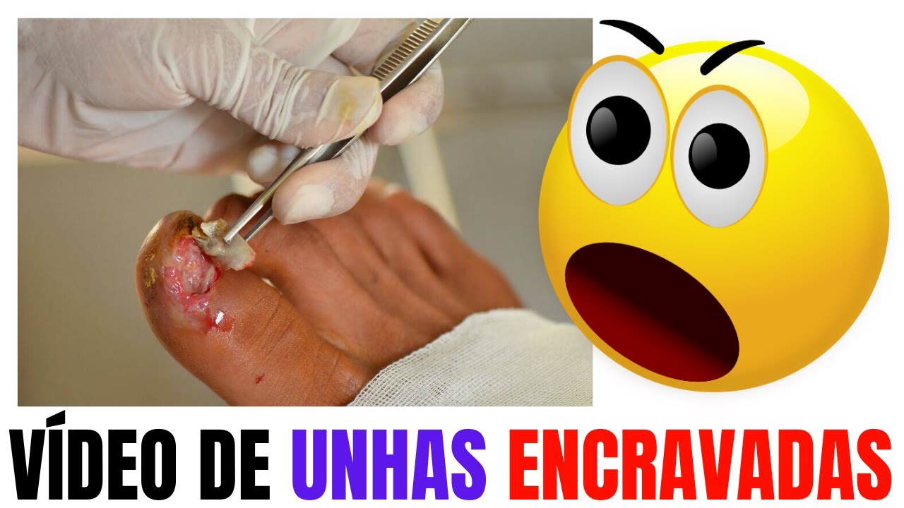 UnhaS EncravadaS, Vídeos de unha encravada, PODOLOGIA, manicures ...