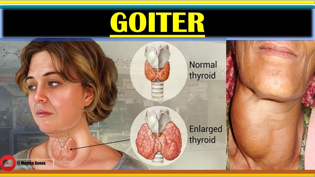 GOITER | ETIOLOGY OF GOITER | MANAGEMENT OF GOITER | GOITER NURSING ...