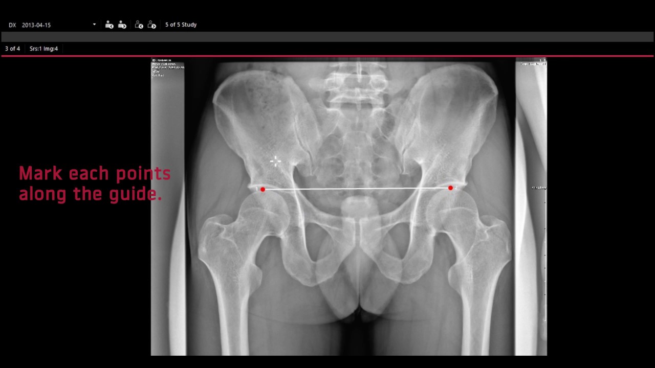 [Vieworks] QXLink Chiropractic Measurement Tools - YouTube
