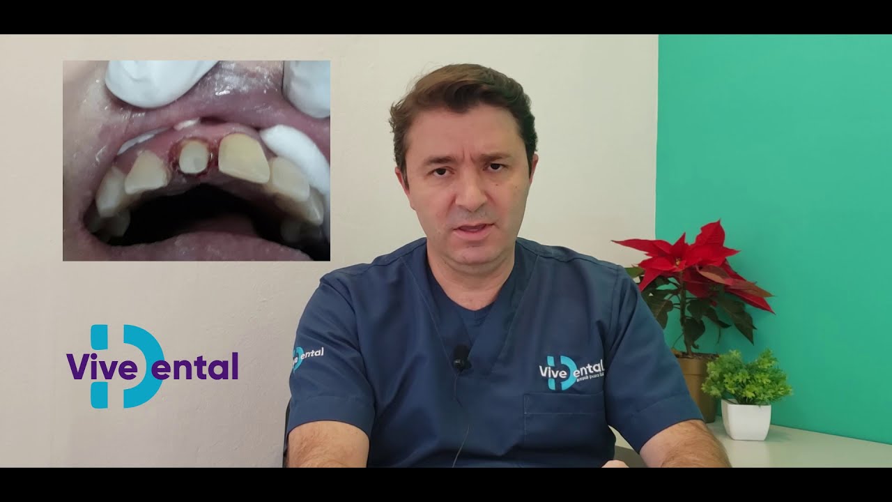 ¿NÚCLEOS COLADOS QUE SON? La rehabilitación oral - YouTube