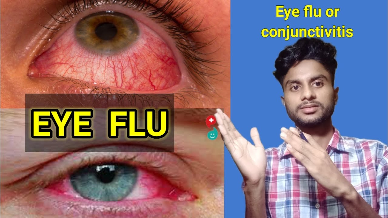 Eye flu or conjunctivitis - YouTube