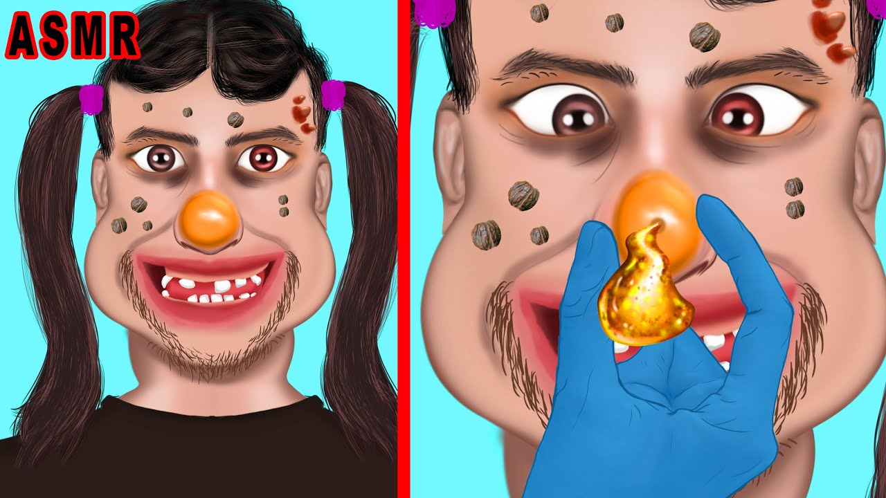 Epic Nose Pimple Pop! 😱 Satisfying and Gross Pimple Popping - YouTube
