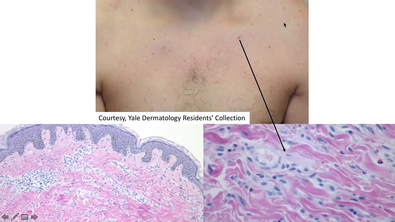DP60 episode 83 pink tan macules and papules on chest - YouTube