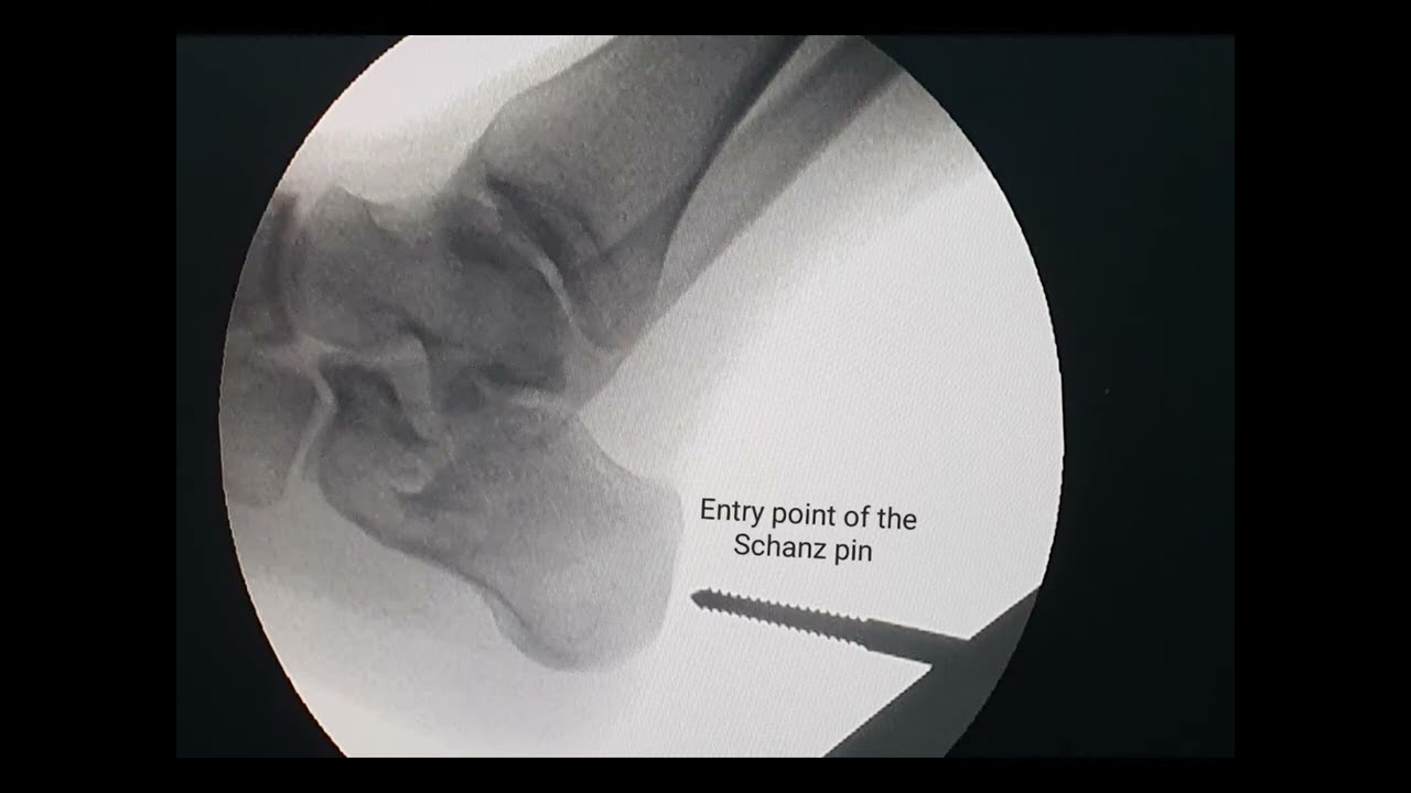 Impacted fracture Calcaneum | Closed reduction | Schanz pin as ...