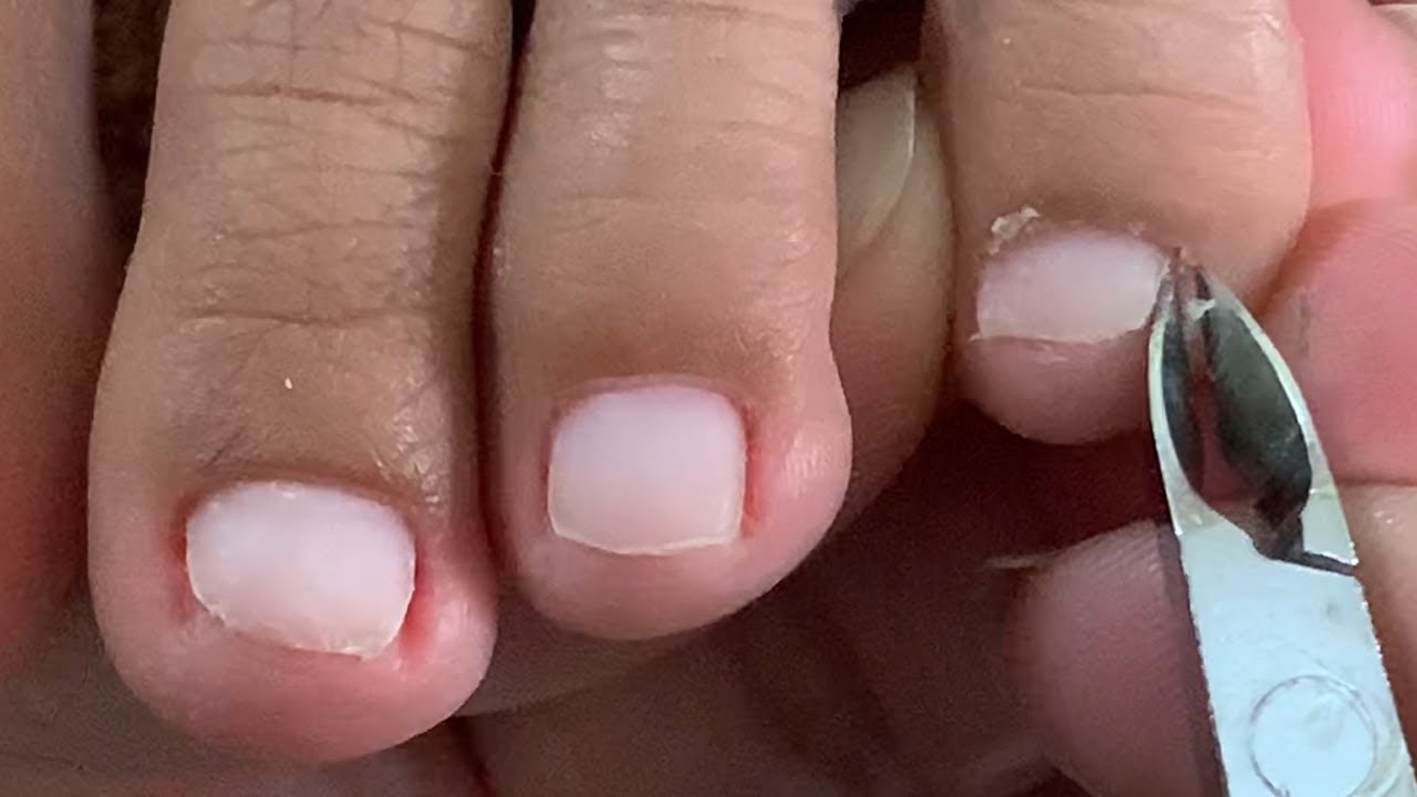 Clean The Skin And Remove The Corner Of The Nail - Ingrown Toenail ...