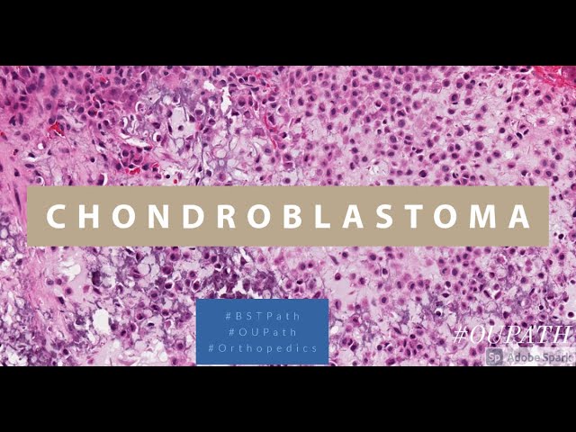Chondroblastoma Pathology Outlines