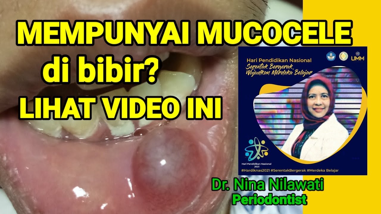 Seputar Mucocele - YouTube
