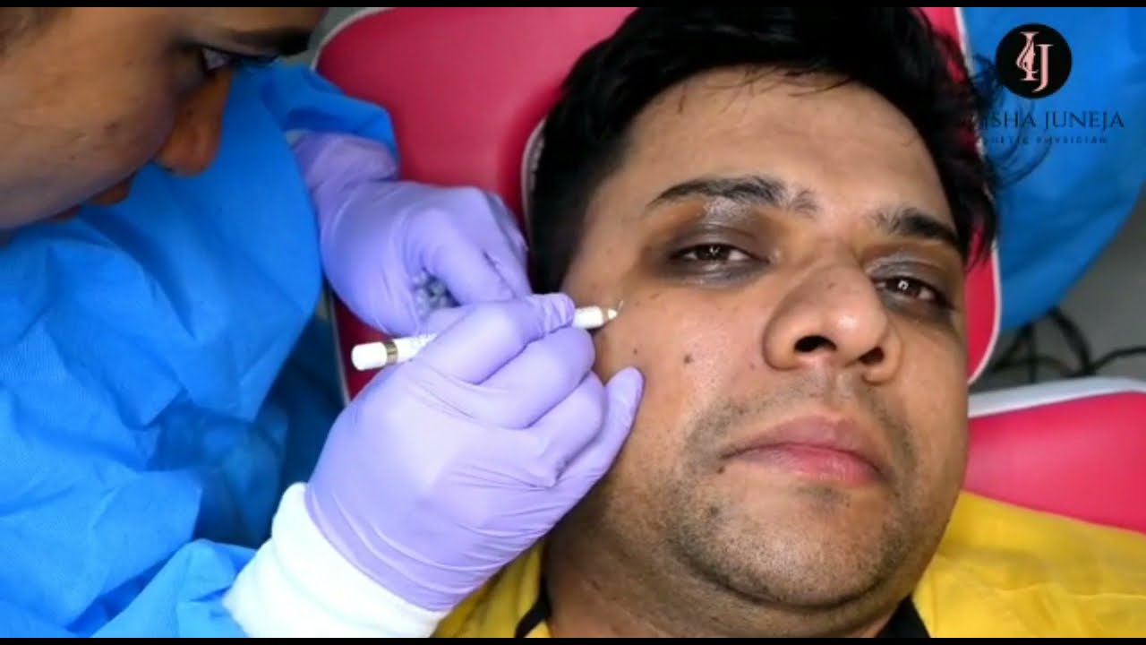 Mono Threads procedure for Acne Scars | Dr. Isha Juneja (Aesthetics ...