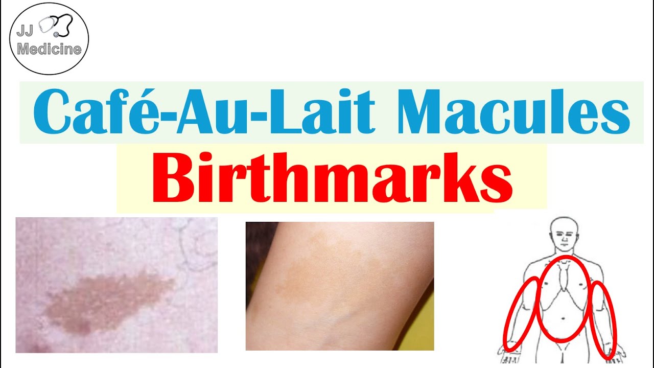 Café-au-Lait Spots: The Hidden Clues Your Skin Is Trying to Tell You ...