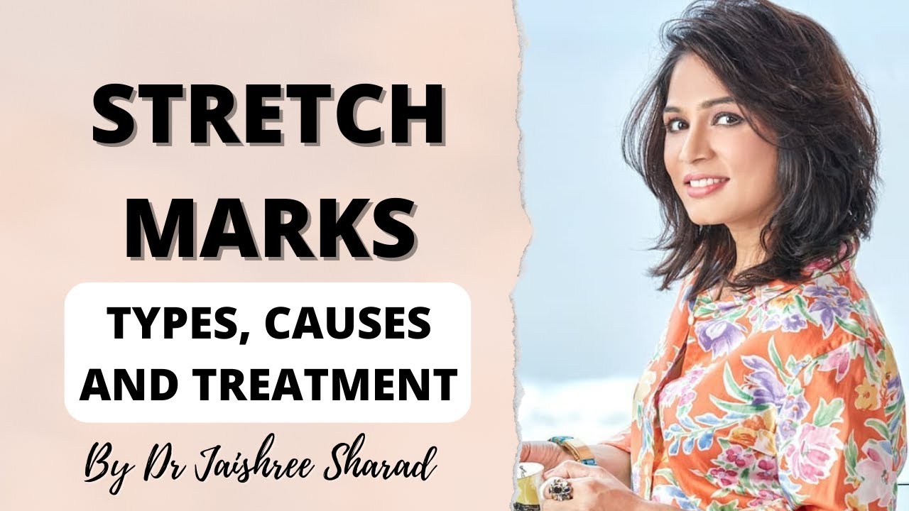 Stretch Marks | Types, Causes and Treatment for stretch marks | By Dr ...