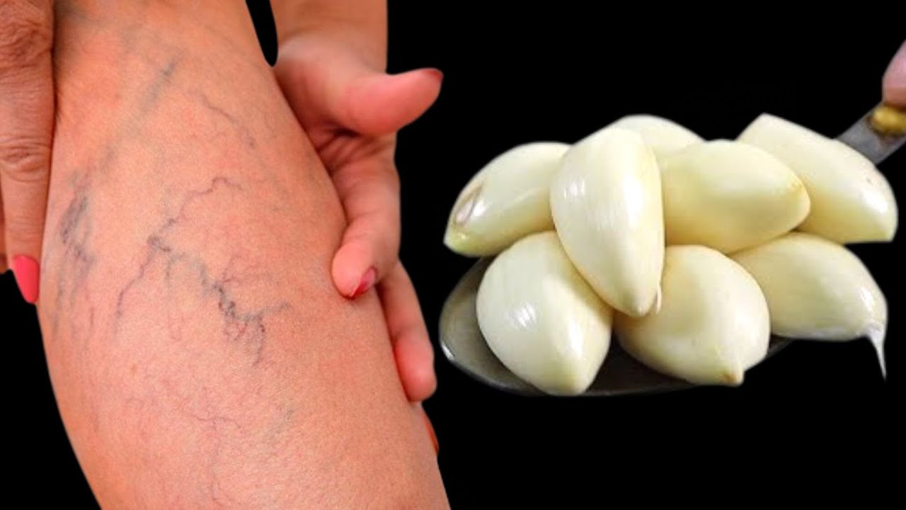 Leg pain, rheumatism, varicose veins, arthritis, headache, joint pain ...