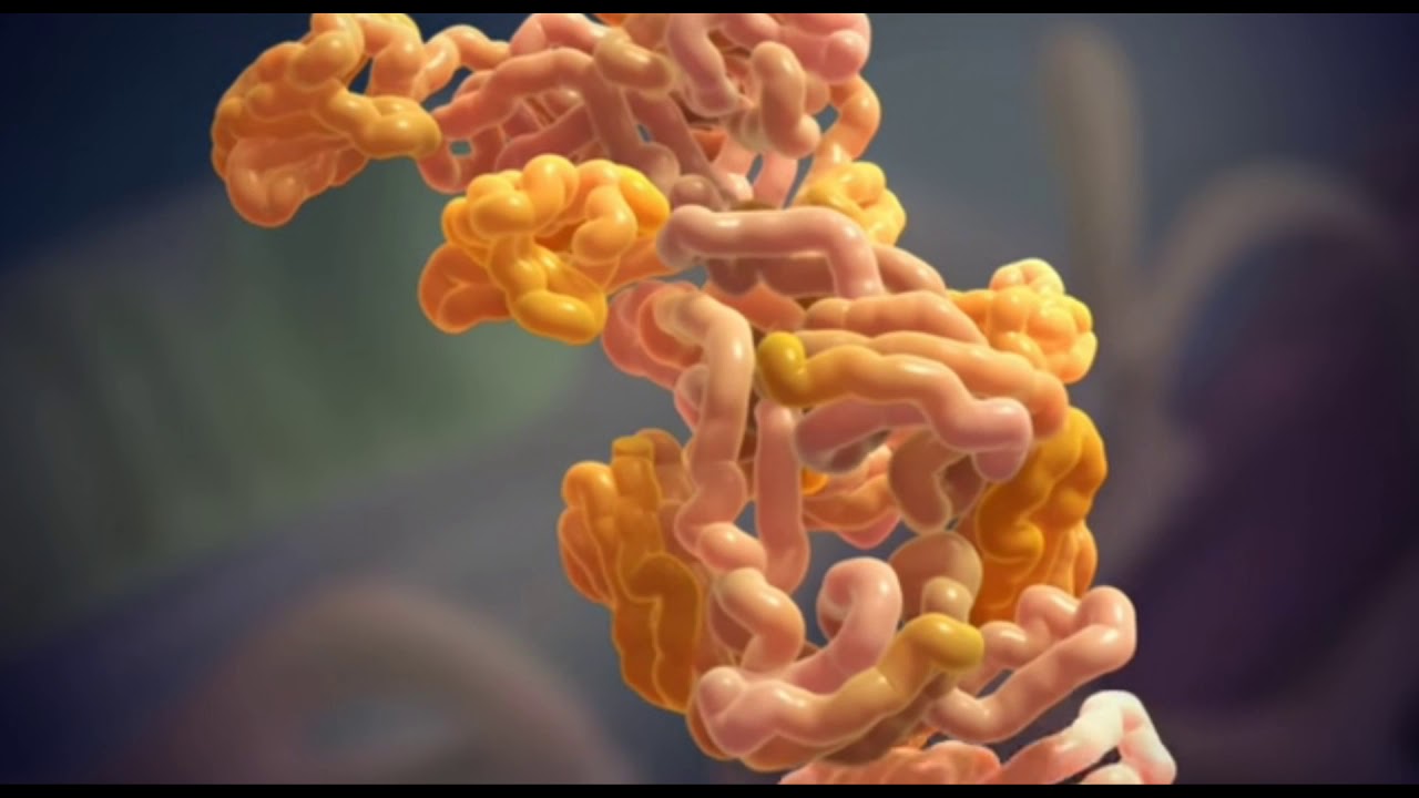 What is AL Amyloidosis - YouTube