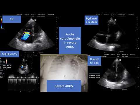 A simple, evidence based way of management of severe ARDS by POCUS ...