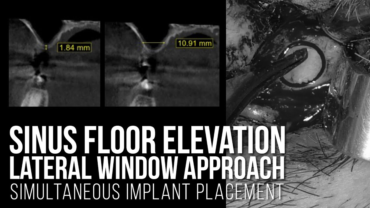 Sinus Floor Elevation - Lateral Window Approach (simultaneous implant ...