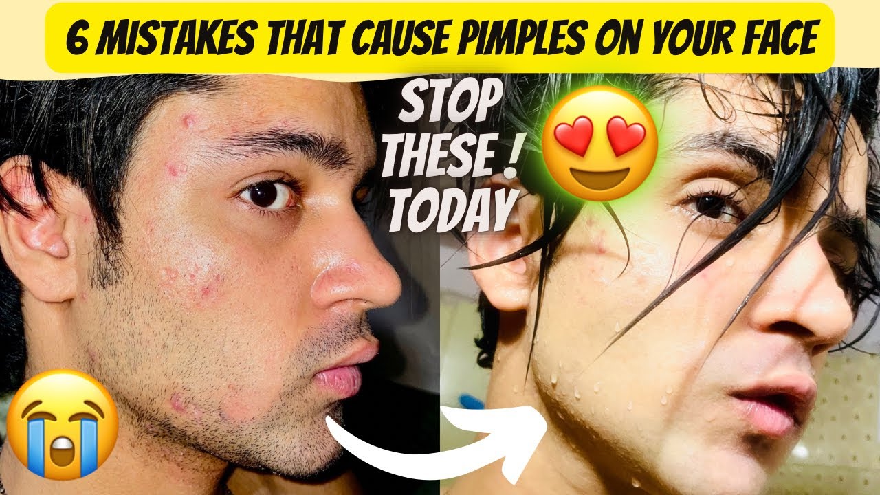 6 PIMPLE MISTAKES | Skin Care Mistakes That Damage Your Skin | Stop ...