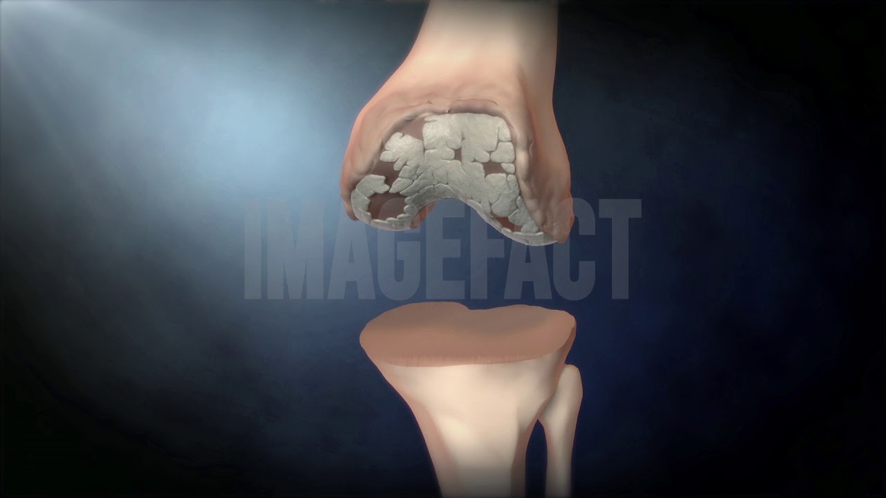 관절,articulatio genu, articulatio genus, knee joint - YouTube