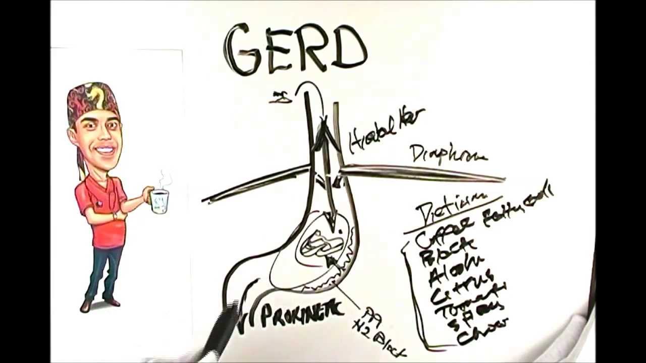 GERD Gastroesophageal Reflux Disease Explained Simply - YouTube