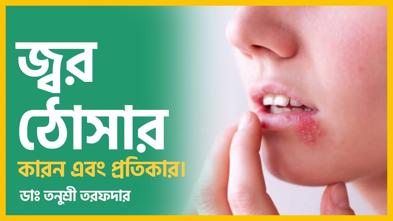 জ্বর ঠোসার কারন এবং প্রতিকার। Causes and treatment of Aphthous Ulcer ...