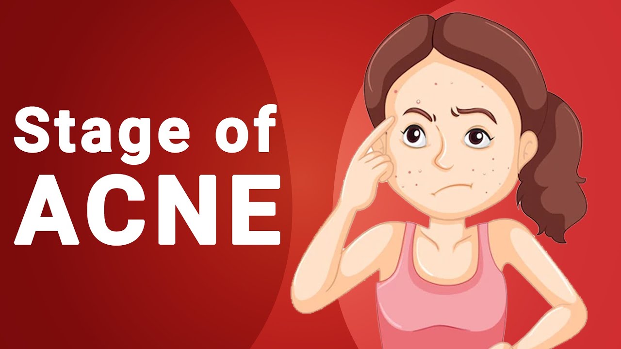 Stage of Acne | skin | biology - YouTube