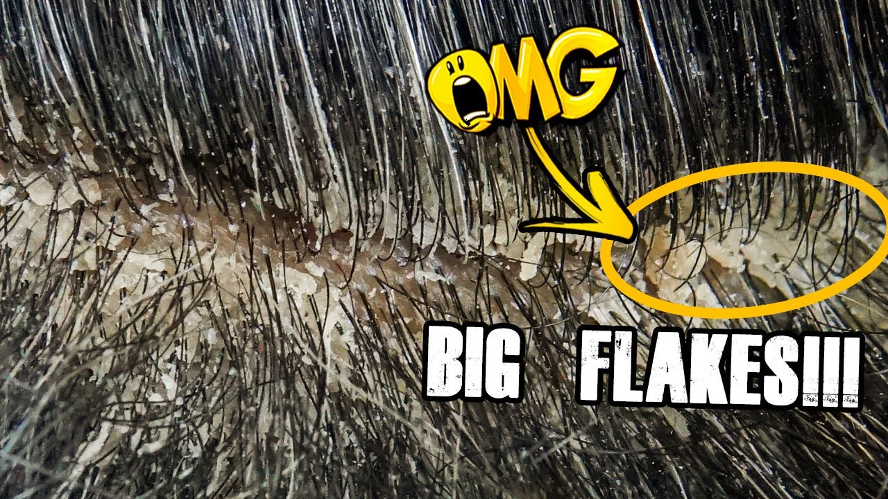 Scratching Big Flakes Off Scalp!! Huge Dandruff Removal - YouTube
