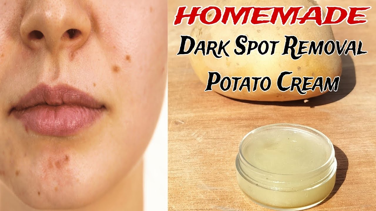 Homemade Dark Spots Removel Cream Get Fair and Clear Skin ln 7 days ...