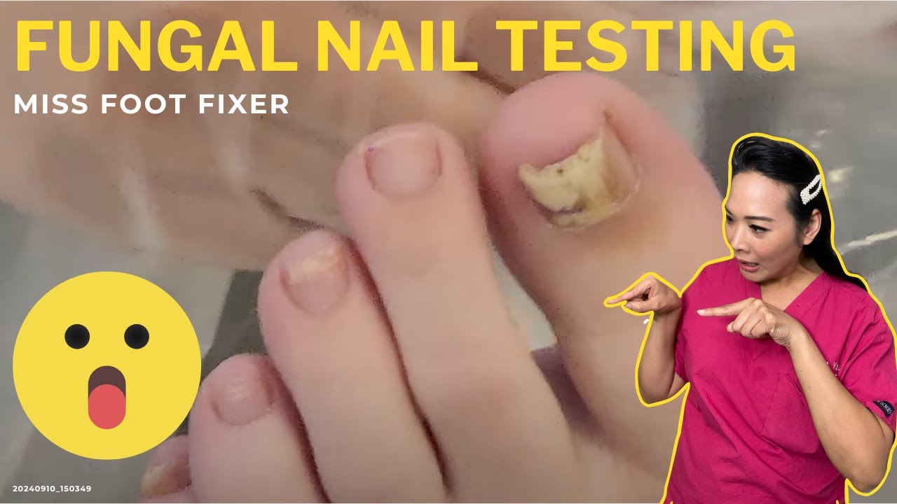 Fungal Nail Testing Process Explained | Diagnosis by a Pro - YouTube