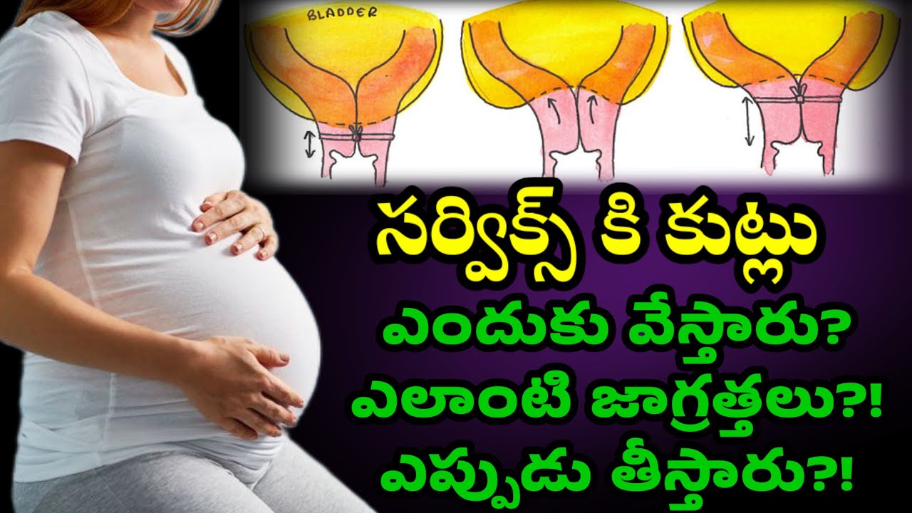 Cervical Stitches During Pregnancy Full Details in Telugu #pregnant # ...