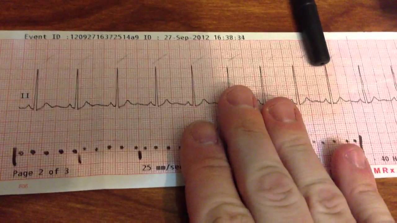 Looking At A Normal 12 Lead ECG YouTube Looking At A Normal 12 Lead ECG YouTube