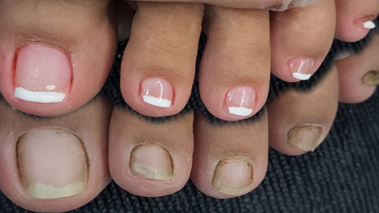 Tanggal ang maduming kuko - YouTube