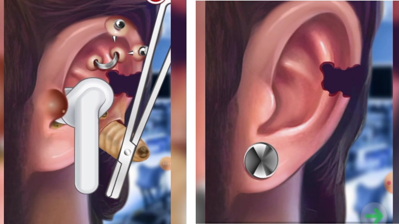 ear cleaning ASMR | water device remove earwax | ear cleaning animation ...