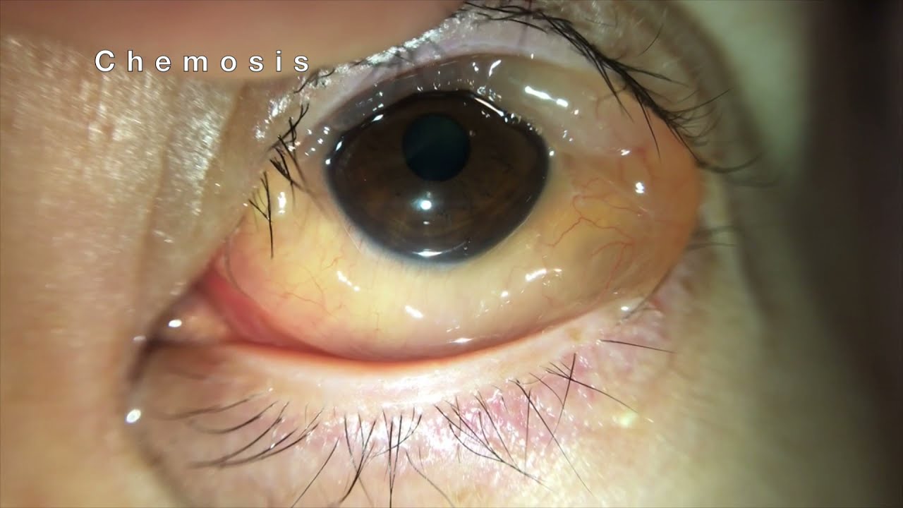 Chemosis of Conjunctiva - YouTube