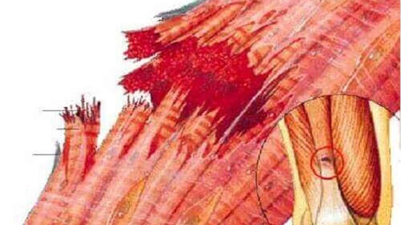 Een spierscheuring: symptomen en behandelingen - YouTube